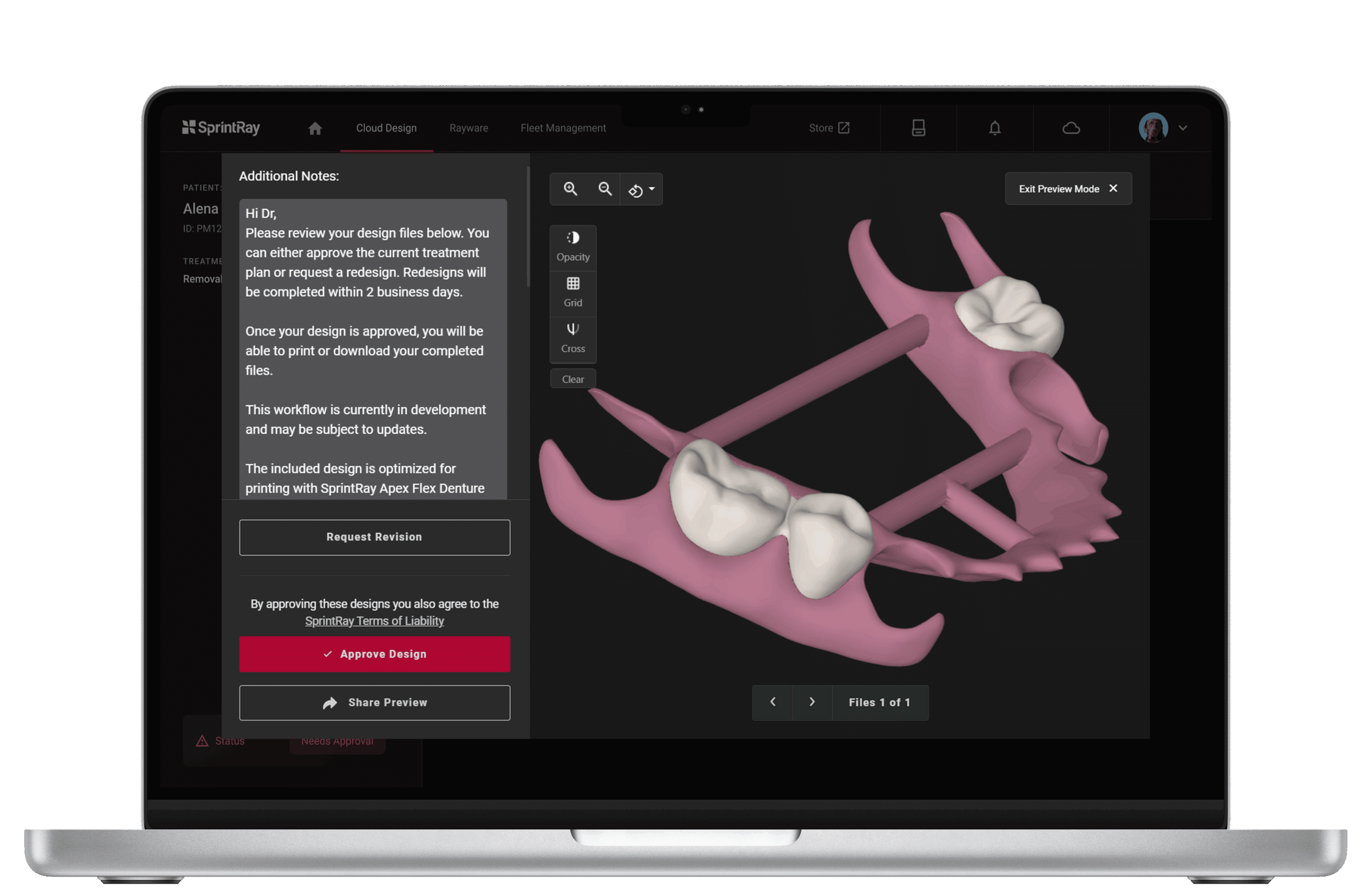 Design and 3D Print Flexible Partial Dentures - SprintRay Inc.